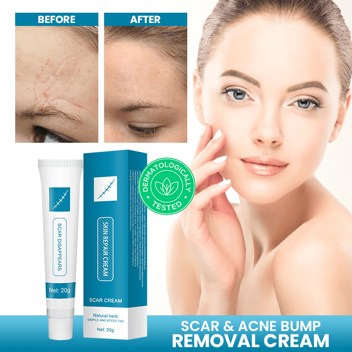 Scar & Acne Bump Removal Cream – KITOYL